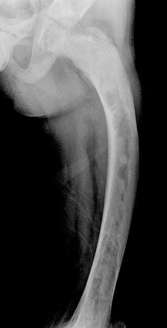 Fibrous Dysplasia X Ray