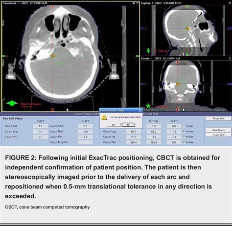 Figure 2 From Intra Fraction Motion Management For Radiosurgical