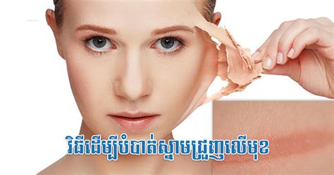 តើ មាន វិធី អ្វី ដើម្បី បំបាត់ ស្នាម ជ្រួញ លើ មុខ