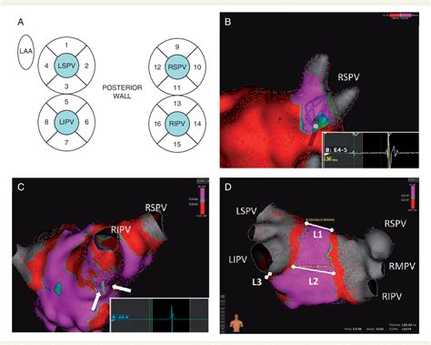 Figure 1 From Differences In Scar Lesion Formation Between Radiofrequency And Cryoballoon In