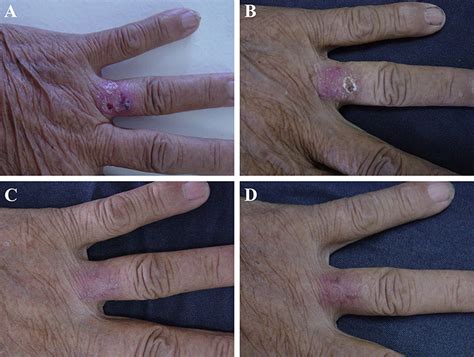 Clinical Analysis Of 49 Patients With Cutaneous Sporotrichosis Idr