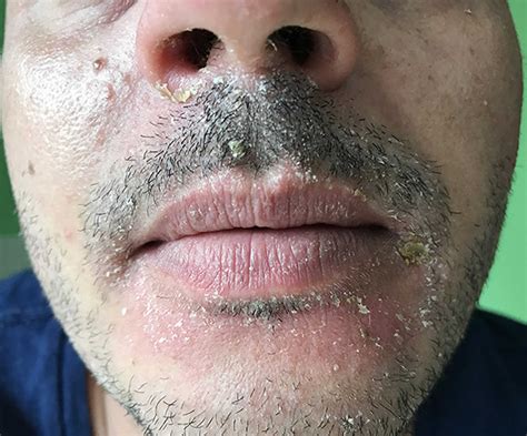 Seborrheic Dermatitis Causes Symptoms Diagnosis Treatment And Prognosis