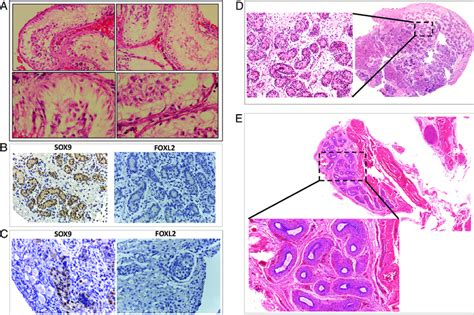 Histology Of Gonads From Patients Showing Testicular Or Ovotesticular