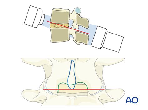 Lumbar Endoscopic Unilateral Laminotomy For Bilateral Decompression Le