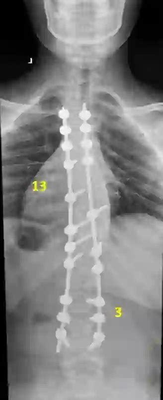 Double Major Curve In An Adolescent