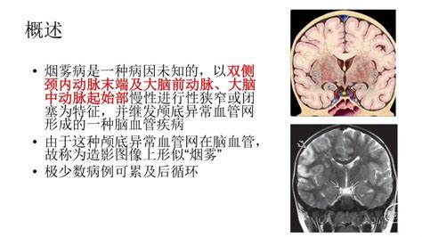 烟雾病的影像学表现 脑医汇