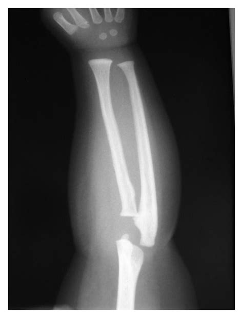 Hypoplasia And Subluxation Of The Head Of The Radius Download Scientific Diagram