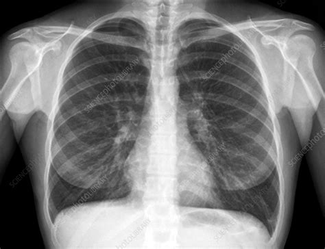 X Ray Of Lungs With Asthma