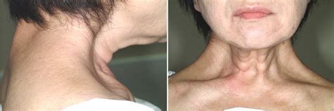 Bilateral Hypertrophy