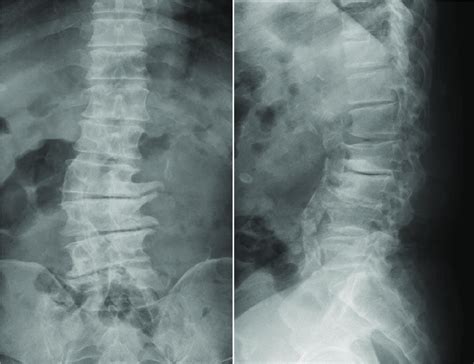 X Ray Shows Degenerative Scoliosis In Lumbar Spine Download