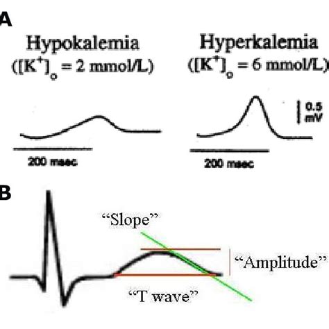 A Alterations In T Wave Due To Different Potassium Level 14 B A
