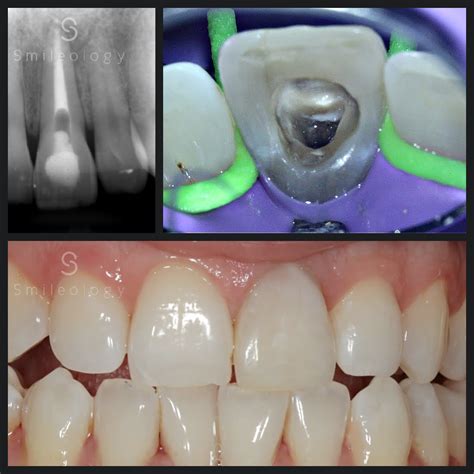 Root Canal Dentist Comprehensive Root Canal Treatment In Maidstone
