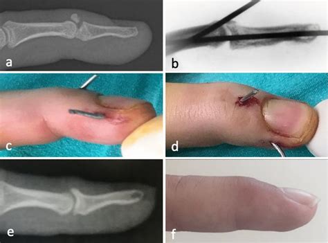 The Extension Block Pinning Technique A Doyle Type 4b Mallet Fracture Download Scientific