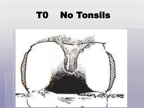 Tonsillar Size Ppt