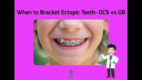 When To Use Ocs And When To Bracket Ectopic Teeth Youtube