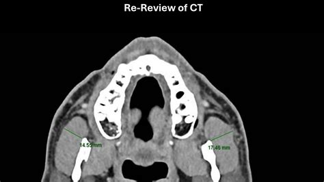 Case 5 Left Parotid Swelling And Pain Iowa Head And Neck Protocols