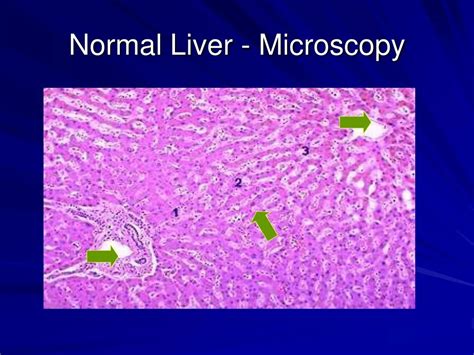 Ppt Liver Cirrhosis Powerpoint Presentation Free Download Id 9552164