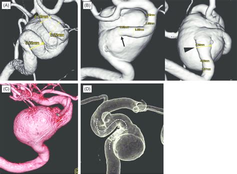 Cases In Which Pipeline Flex Deployment Was Relatively Difficult A