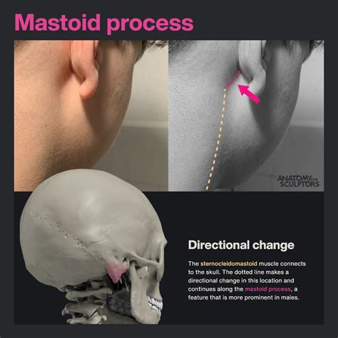 Mastoiditis Anatomy