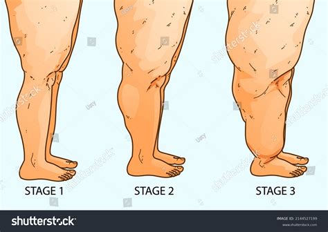 Stages Lipedema Womens Legs Health Problems Stock Vector Royalty Free