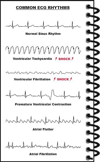 Common ECGs Shockable V Fib V Tach Nurse Cardiac Nursing Nursing Babe Survival