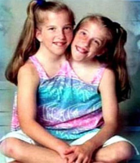 4对罕见连体双胞胎：共用上半身的姐妹当上老师 每日头条