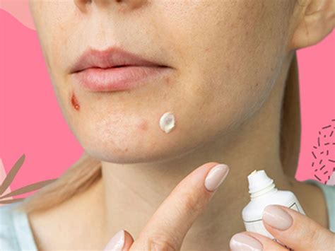 از بین بردن جوش با خمیر دندان