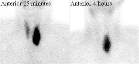 Parathyroid Scan With Intravenous Technetium 99m Download Scientific Diagram