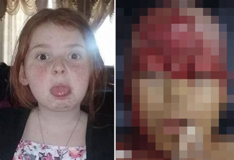 【閲覧注意】遊園地の絶叫マシン、11歳の少女を恐ろしい姿に変える・・・（画像あり） ポッカキットポッカキット