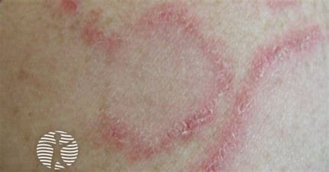 Subacute Lupus Erythematosus Image