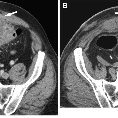 Hinchey Iii Acute Colonic Diverticulitis In A 49 Year Old Man Download Scientific Diagram