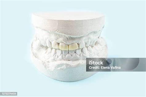 천박석 주조 푸른 배경에 인간의 턱과 치아의 금형 의치 중괄호 또는 거짓 치아의 제조를위한 치과 주조 석고 치과 및 치열 교정 개념 0명에 대한 스톡 사진 및 기타 이미지