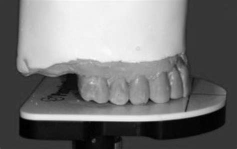 Treatment Planning And Execution Of The Complex Restorative Case