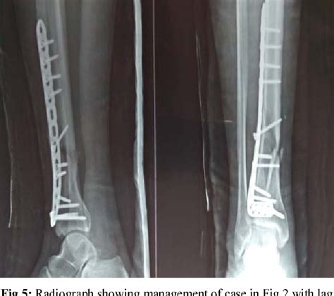 Figure 6 From Management Of Comminuted Distal Metaphyseal Tibial Fractures With 3 5 Mm