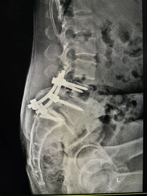 Causes and Treatments of Failed Back Surgery Syndrome