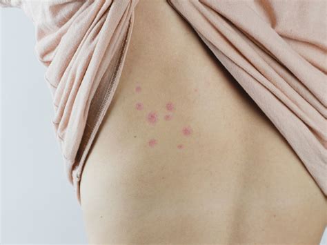 Is There A Pattern To Bed Bug Bites Bed Bug Heat Treatment