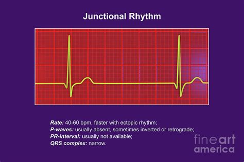 Junctional Rhythm Of The Heartbeat 1 By Kateryna Konscience Photo Library