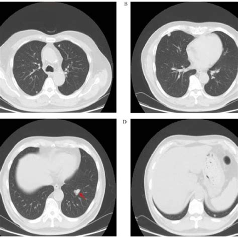 Mri Scan Revealed A Malignant Mass Size 63x39x83 Mm In The Triceps