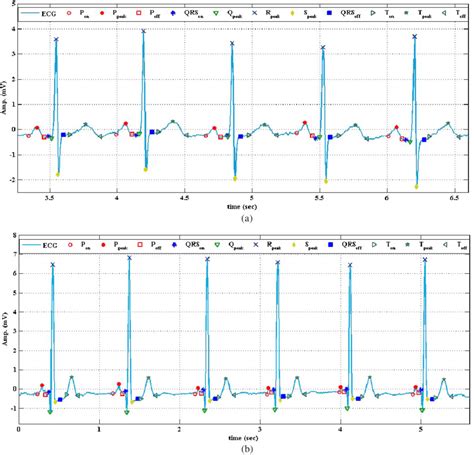 Segmentation Results For Two Typical Ecg Signals A Fiducial Points Download Scientific