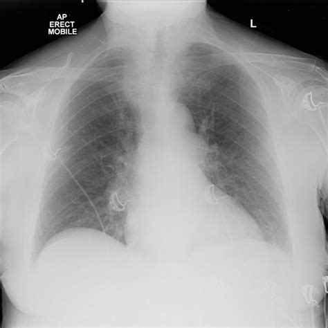 Normal Chest X Ray Female Identifying Sarcoidosis In A Chest X Ray