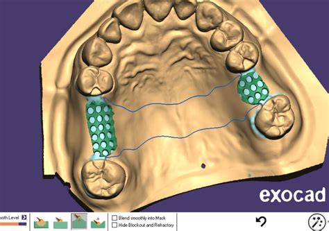 Exocad Partial Framework Preview 2018 01 Dentalligent Blog