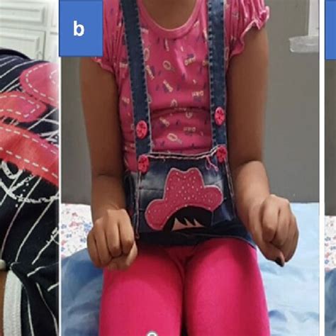 Diagrammatic Description Of Judet Classification Of Radial Neck Fractures Download Scientific