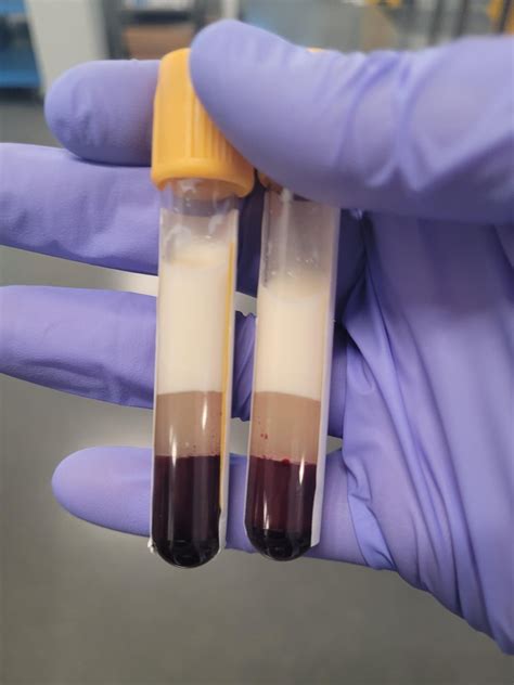 Just A Touch Of Lipemia R Medlabprofessionals
