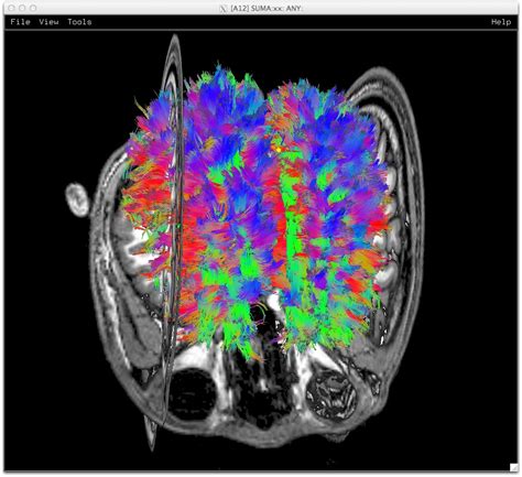 62 Suma Viewer — Afni Suma And Fatcat V25212