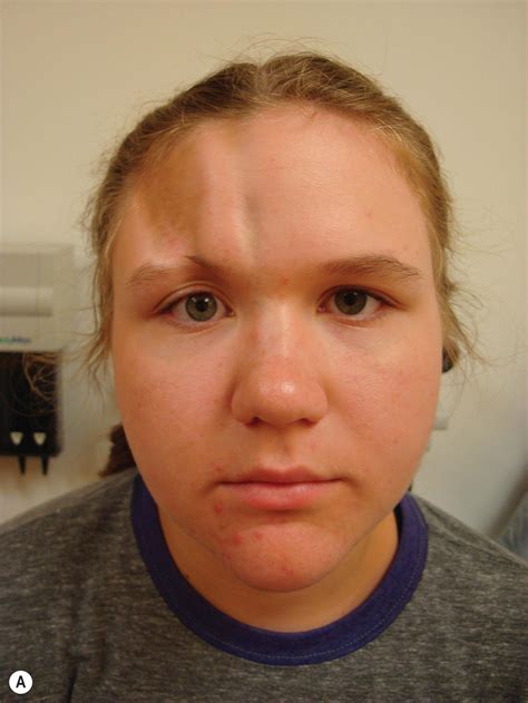 Idiopathic Progressive Hemifacial Atrophy Clinical Tree