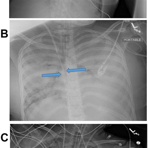 Extracorporeal Circuit Configuration And Pulmonary Arterial