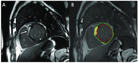 Assessment Of Myocardial Late Gadolinium Enhancement Lge In A
