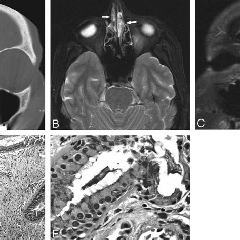 A 60 Year Old Woman With Reah Of The Bilateral Olfactory Recesses A