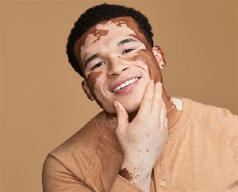 Actors With Vitiligo 60 Photos Moonagedaydreamfilm