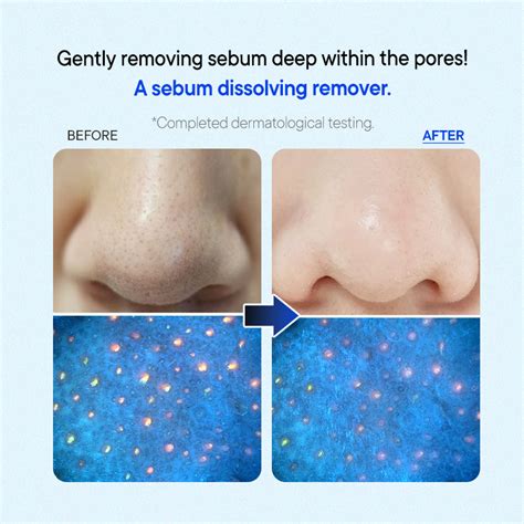 Blackhead Andsebum Removal Pore Cleansing No Pain One Days You Pz